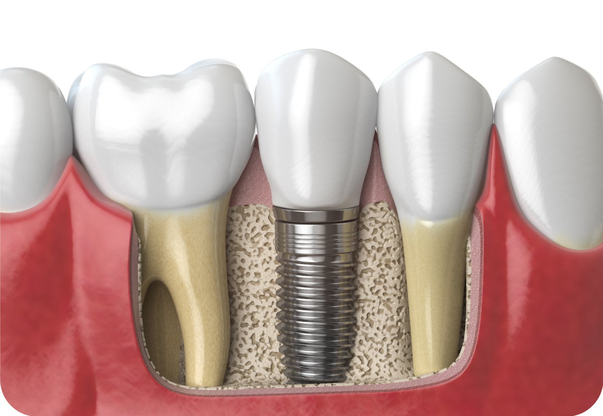 The Science Behind All-on-4 Implants: Why They Are So Effective ...